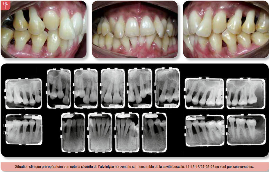 Parodontite grade C stade 4 (agressive sévère) et orthodontie - AOnews ...