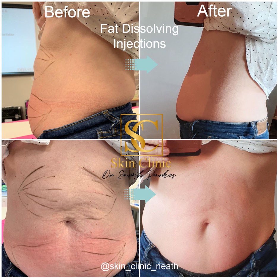 Aqualyx Fat Dissolving Injections Skin Clinic Aqualyx Fat Dissolving Injections Skin Clinic