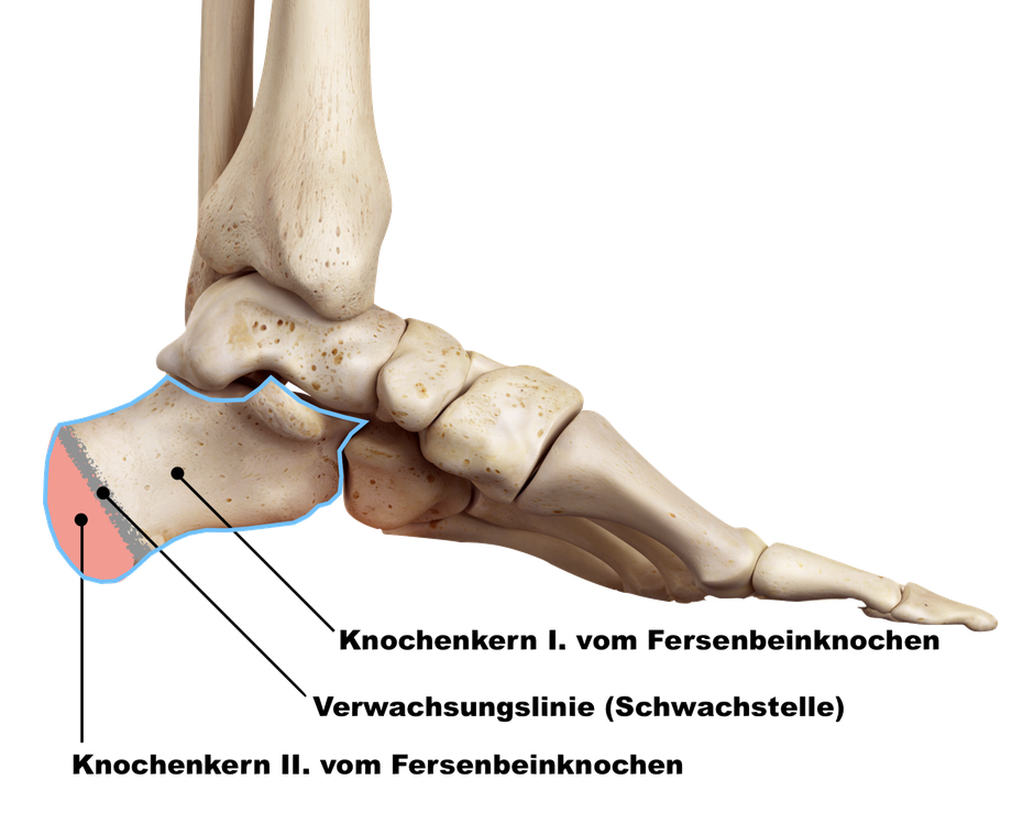 Behandlung Apophysitis Calcanei - Morbus Sever - FERSOmed®