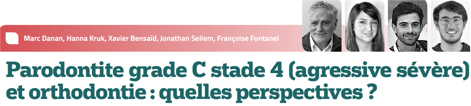 Parodontite grade C stade 4 (agressive sévère) et orthodontie - AOnews ...