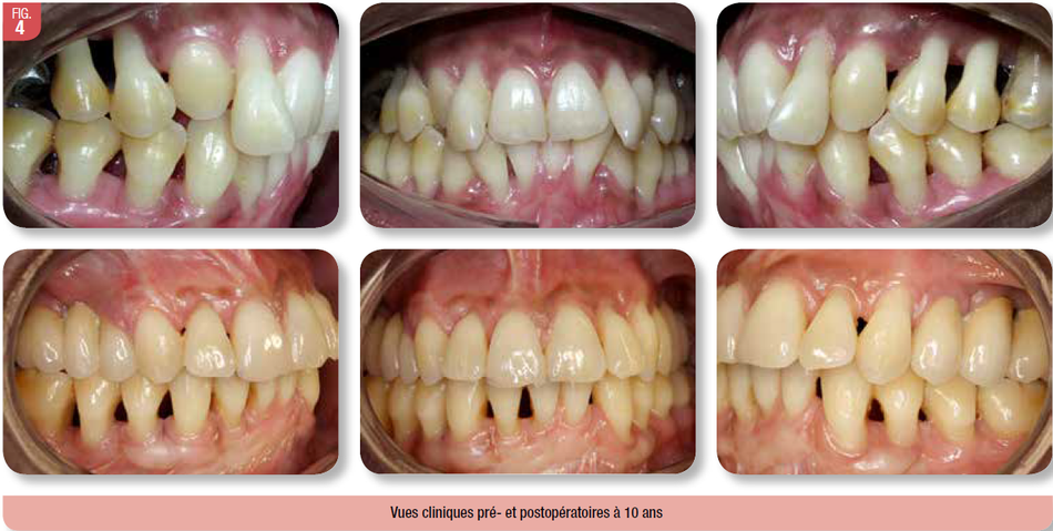 Parodontite grade C stade 4 (agressive sévère) et orthodontie - AOnews ...