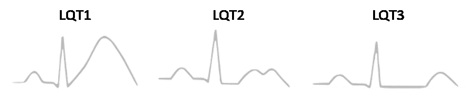Long-QT-Syndrom - Fokus-EKG