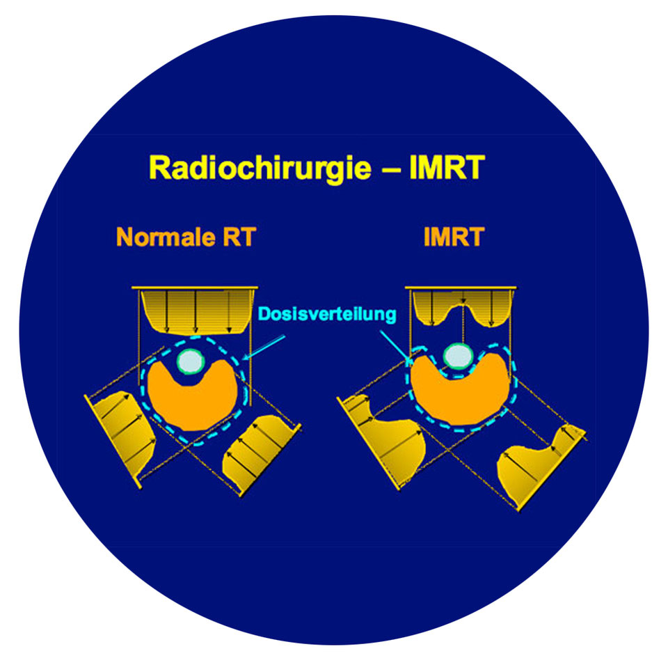 IMRT Bestrahlung / Rapid Arc - die StrahlenTherapeuten