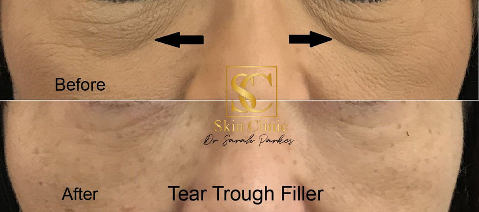 Tear Trough filler injections - Skin Clinic