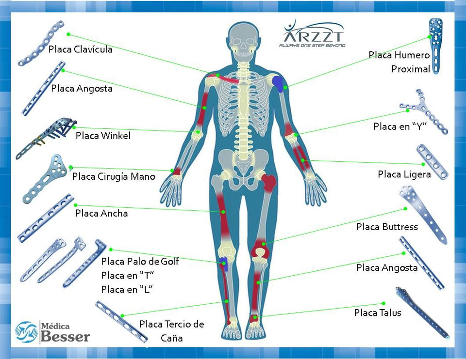 OSTEOSÍNTESIS - Medica Besser SA de CV