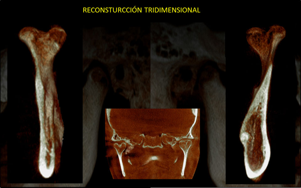 Caso Nº593: Cóndilo Bífido Bilateral - CDI