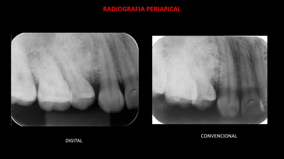 Caso N°621: CEMENTOBLASTOMA - CDI