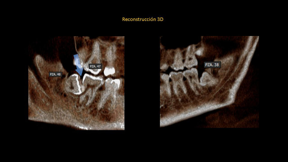 Caso N°570: Reabsorción Radicular Externa por Impactación Dentaria - CDI
