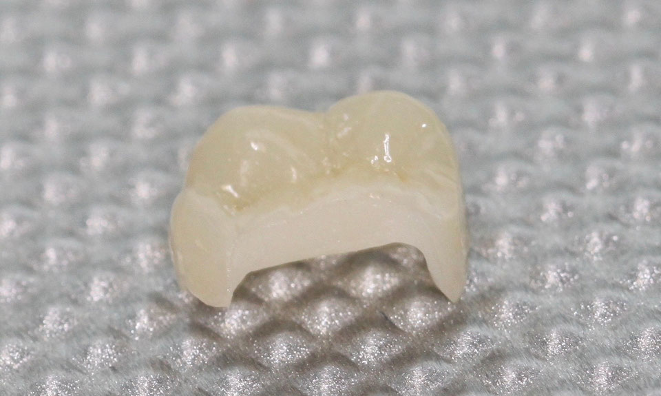 Teil - Kronen & Onlays schonen Zahnhartsubstanz - Zahnarzt Hauzenberg ...