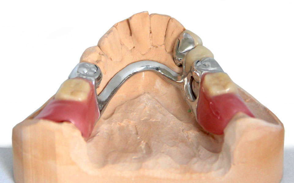Modellgussprothese - Zahnarztpraxis Dr. Marco Bochmann