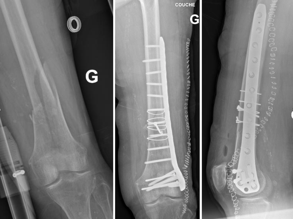 FRACTURES DU GENOU - Dr Rémi : chirurgien orthopédiste à Toulouse
