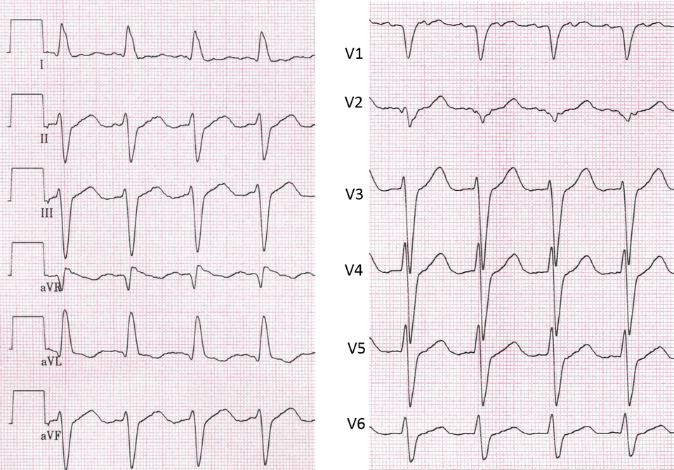 Faszikuläre Blockierungen (inkl. bi- und trifaszikulärer Block) - Fokus-EKG