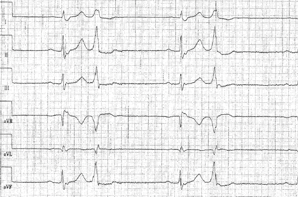 Sagittaltyp - Fokus-EKG