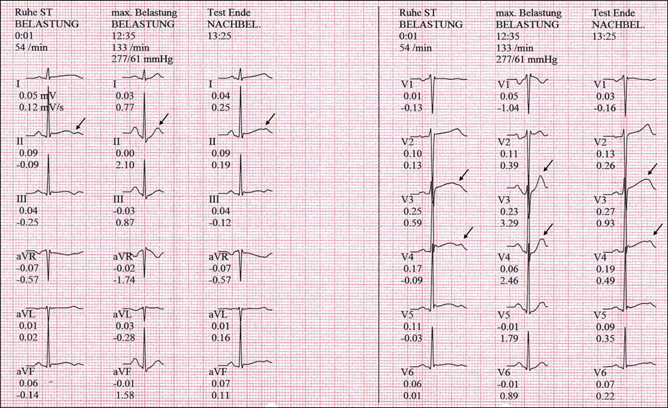 Long-QT-Syndrom - Fokus-EKG