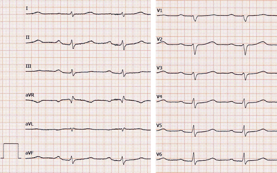 Sagittaltyp - Fokus-EKG