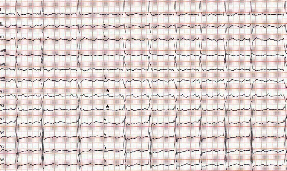Vorhofflattern - Fokus-EKG