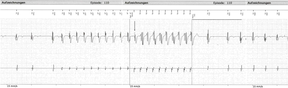 Implantierbarer Kardioverter/Defibrillator - Fokus-EKG
