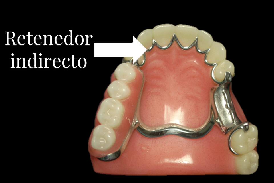 Componentes esenciales de una prótesis parcial removible - Página web ...