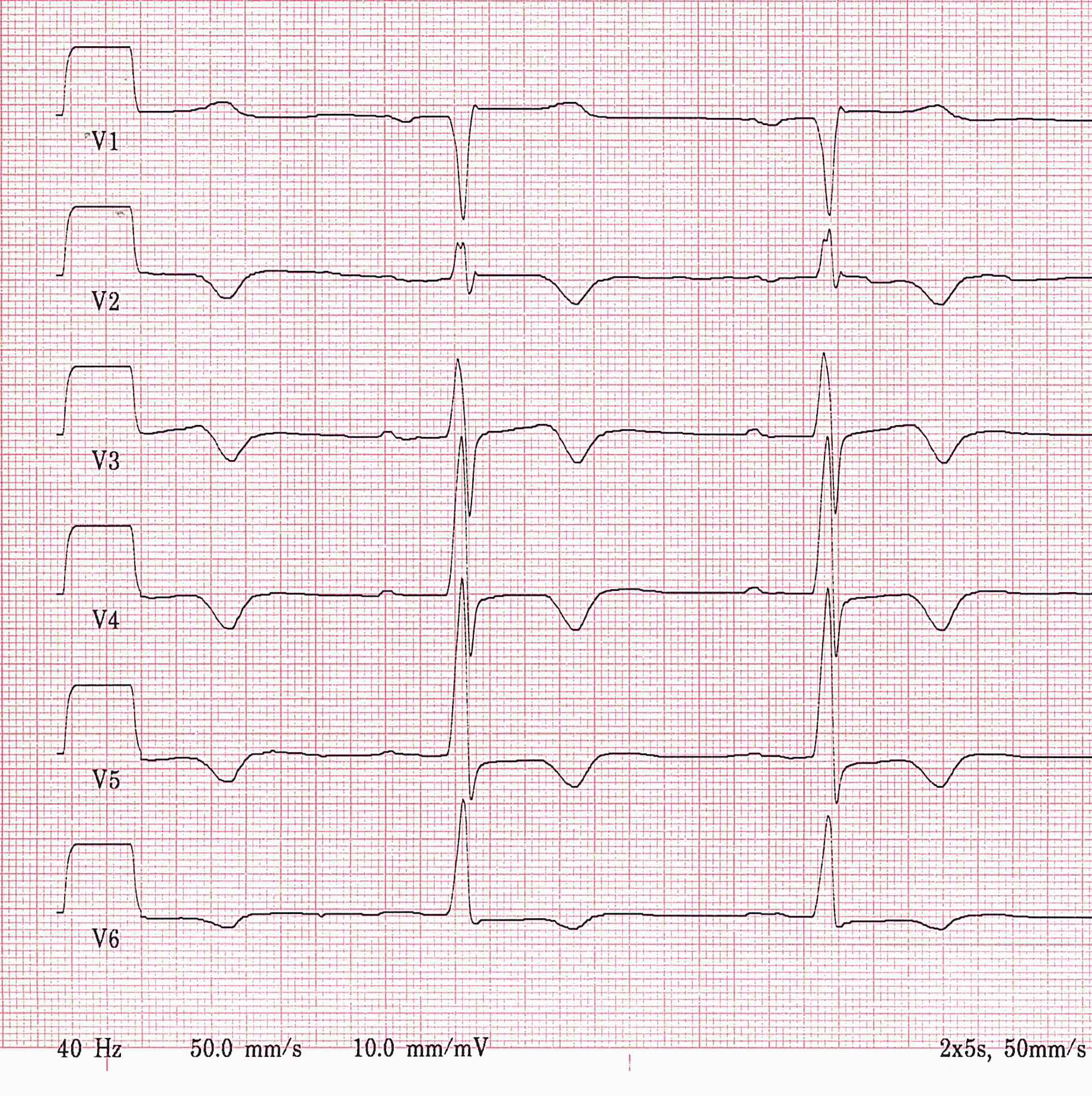 EKG bei hypertropher Kardiomyopathie - Fokus-EKG