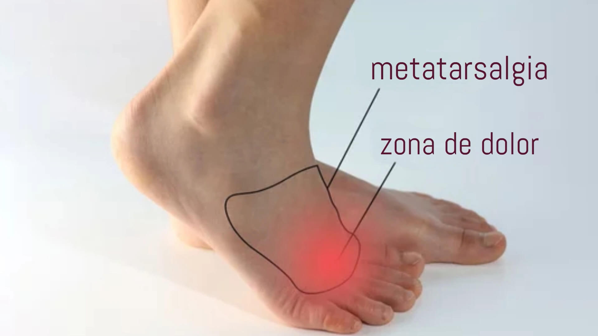 TRATAMIENTO METATARSALGIA CON FISIOTERAPIA - ️ San Javier Fisioterapia