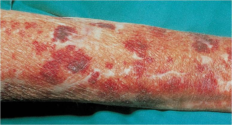 Eczéma : l’unité phalangette pour doser les dermocorticoïdes - Eczéma ...