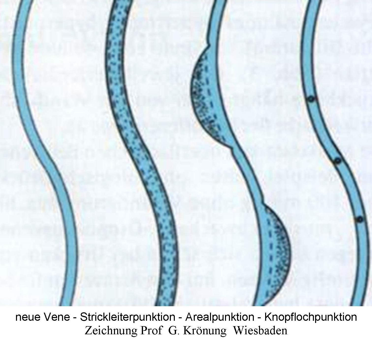 Die fünf Punktionsarten des Dialyseshunts - Mit der richtigen Strategie ...