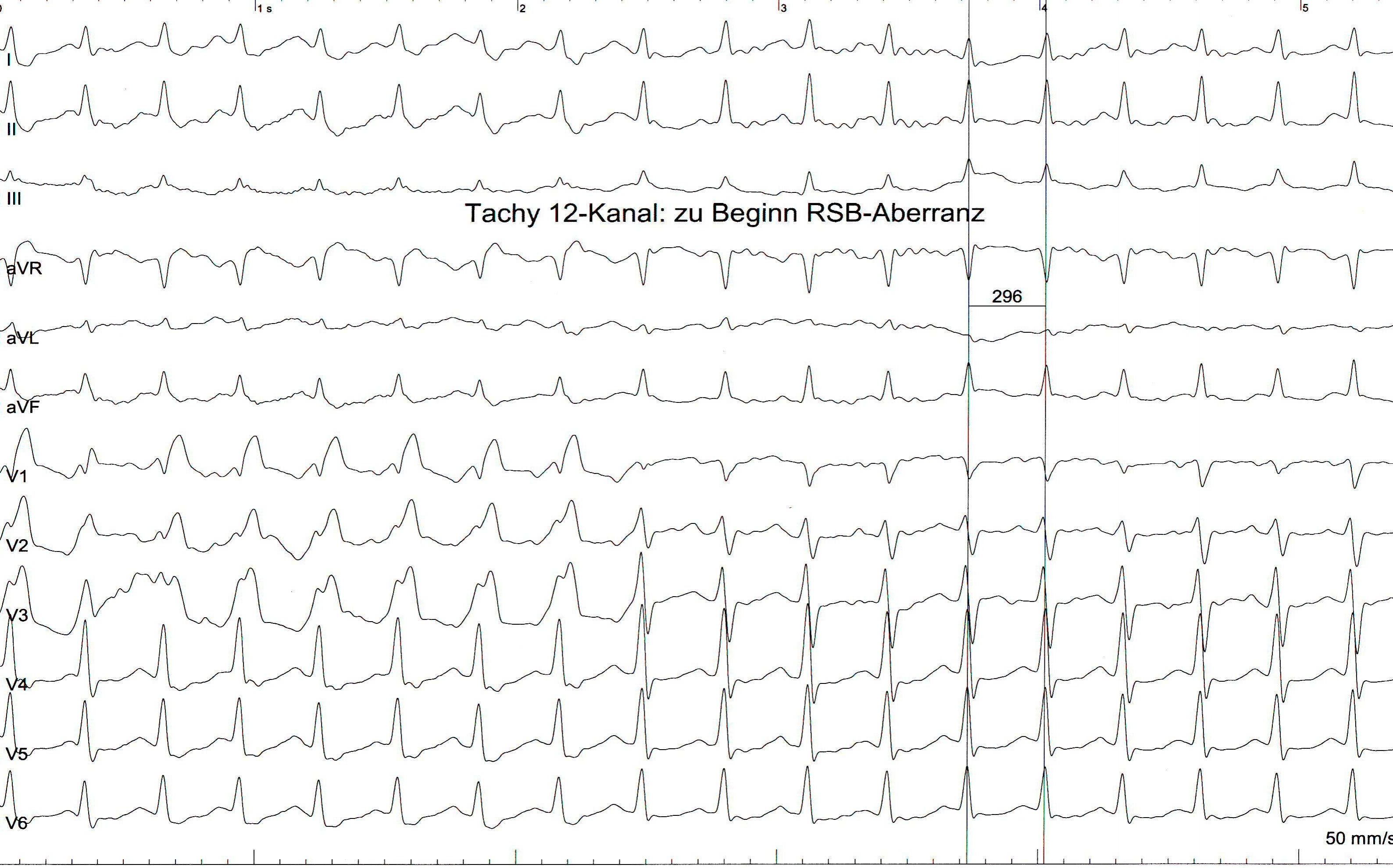 AV-Reentry-Tachykardie und ventrikuläre Präexzitation (WPW-Syndrom ...