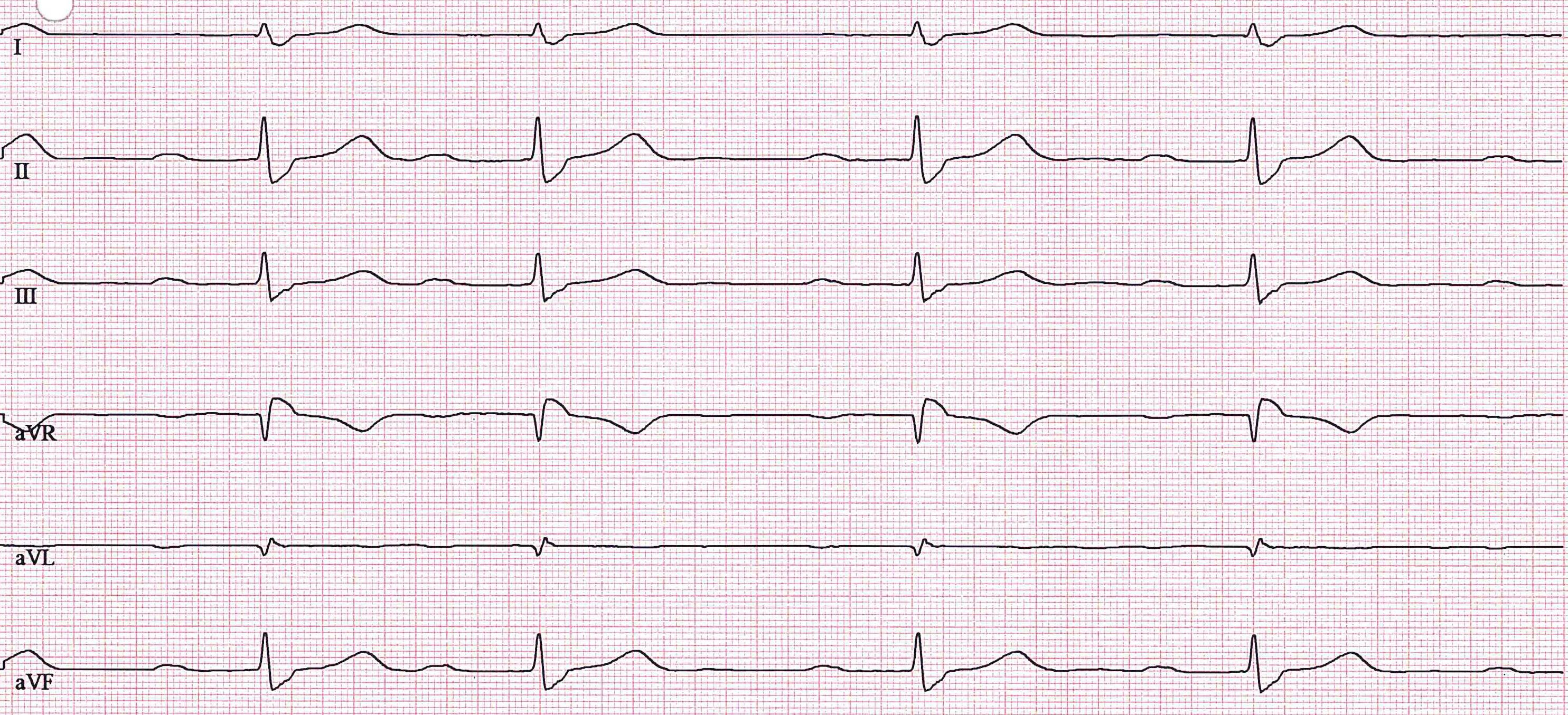 Rechtsschenkelblock im EKG - Fokus-EKG