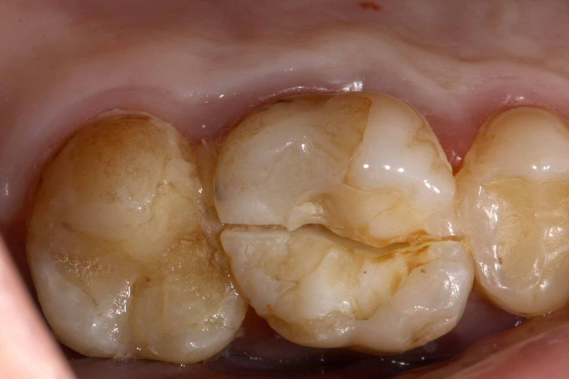 Wurzelbehandlung - Burbach-Zahnarzt Groß-Umstadt Dieburg Babenhausen