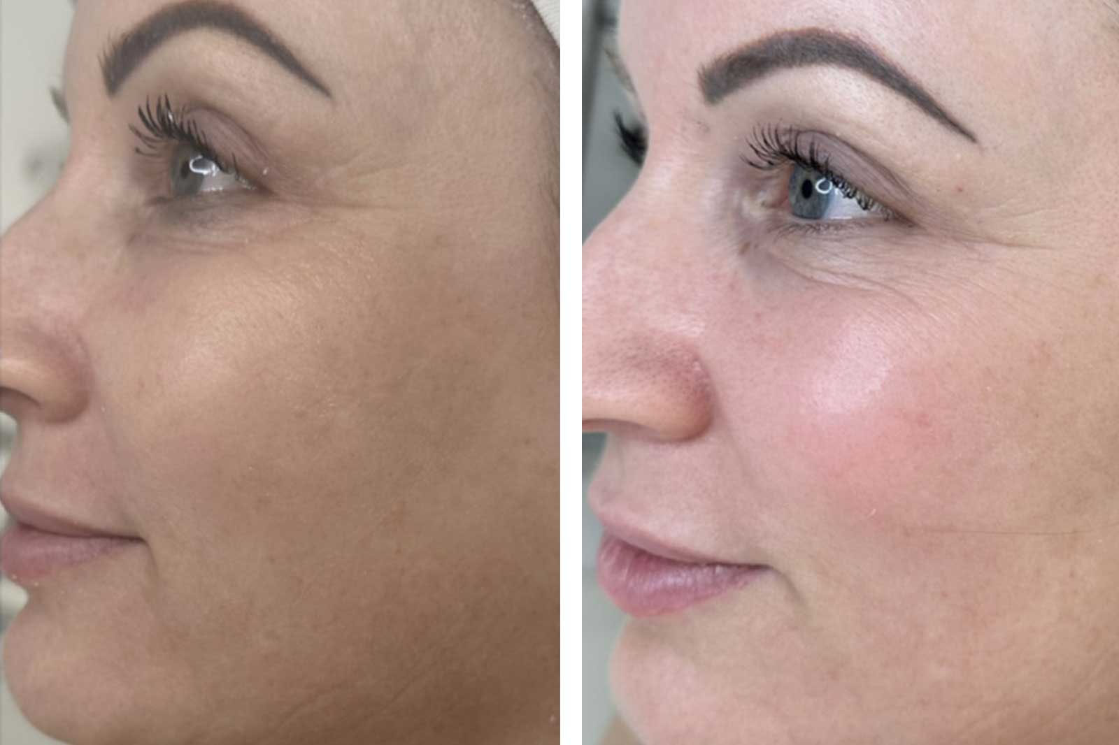 BIO-MICRONEEDLING - Beauty4You-Bergedorf