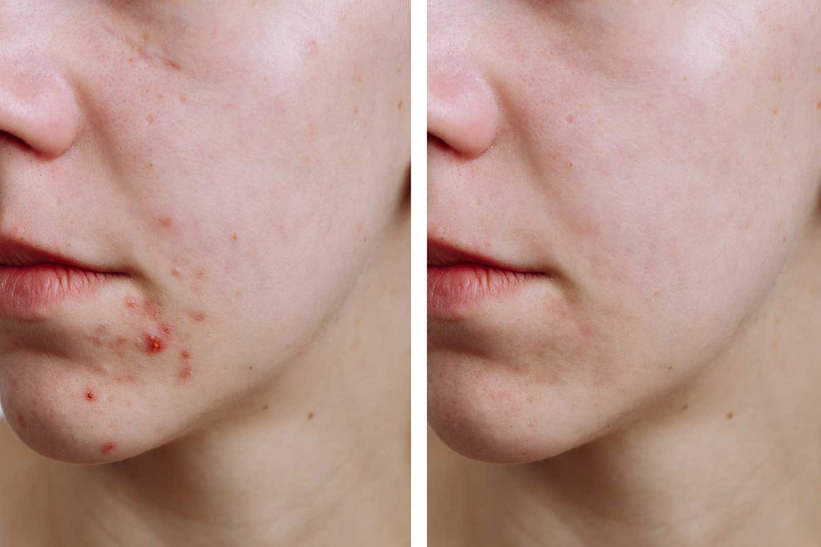 BIO-MICRONEEDLING - Beauty4You-Bergedorf