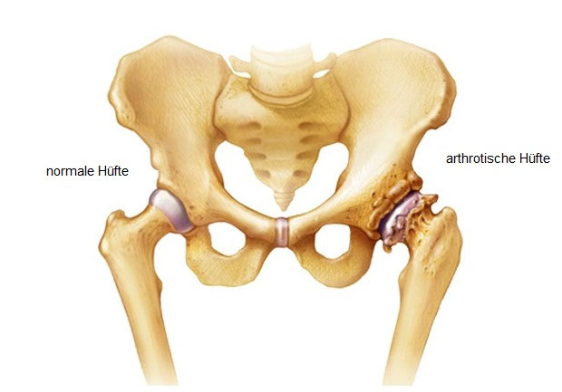 Coxarthrose = Hüftgelenksarthrose - ortho-clinics Webseite!