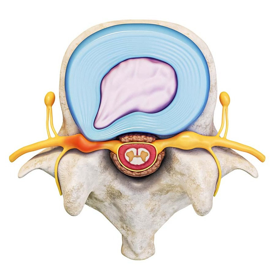 Cruralgie : définition, symptômes, traitements et prévention - PRO-TMS