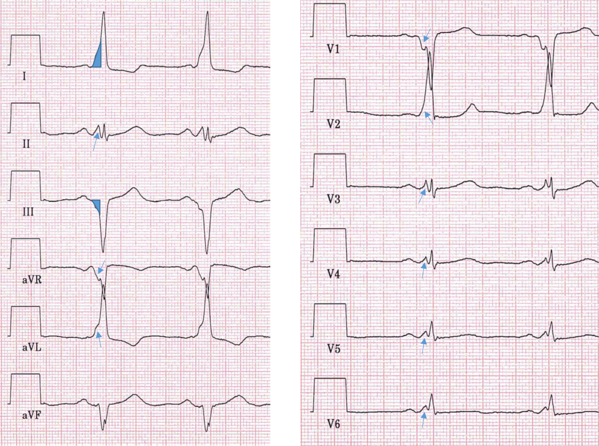 AV-Reentry-Tachykardie und ventrikuläre Präexzitation (WPW-Syndrom ...