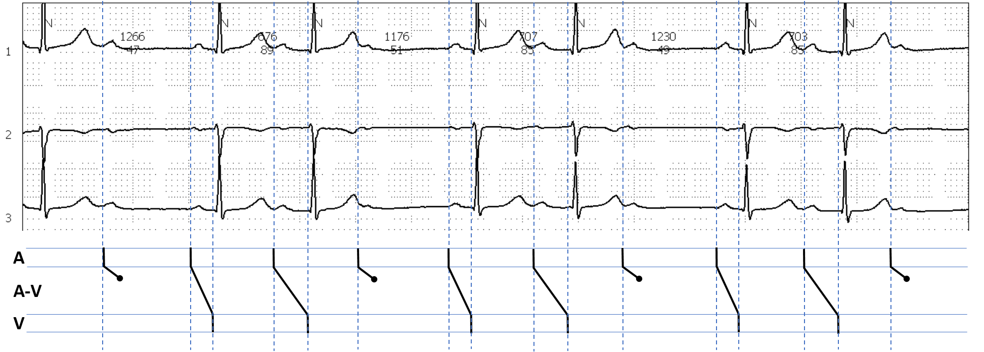 Atrioventrikuläre Blockierungen - Fokus-EKG