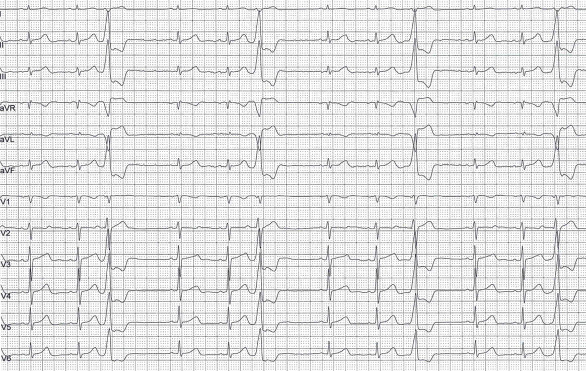 Ventrikuläre Extrasystolen - Fokus-EKG