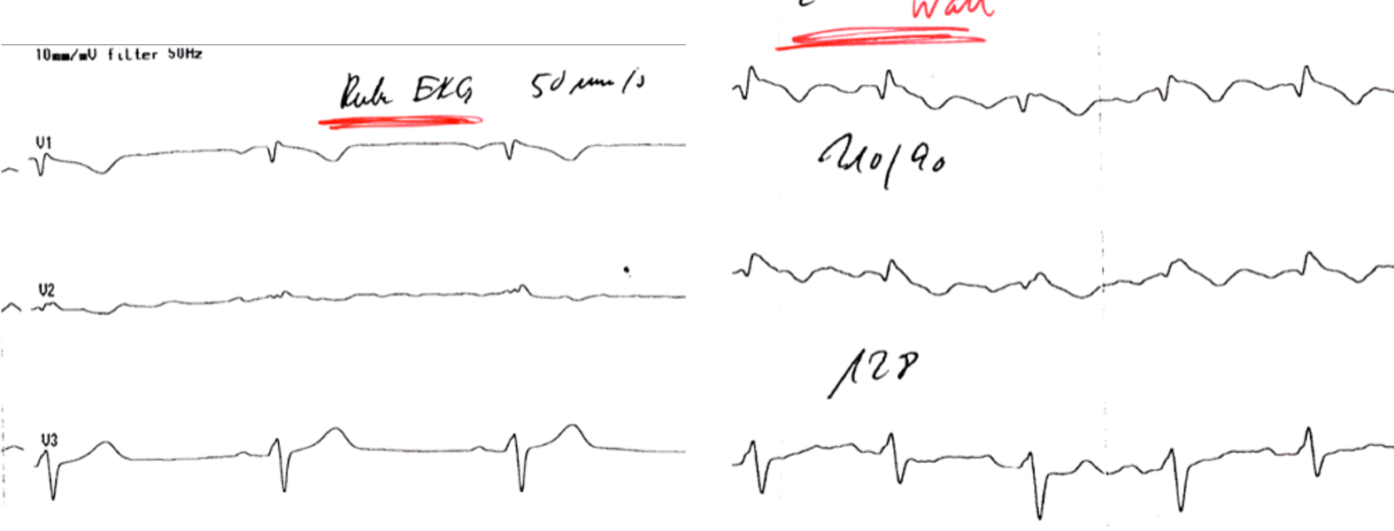 Brugada-Syndrom - Fokus-EKG