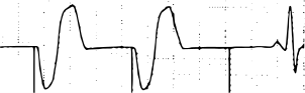 Konventioneller Schrittmacher - Fokus-EKG