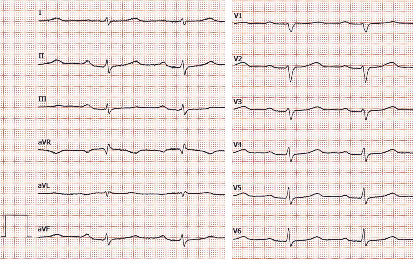 QRS-Komplex - Fokus-EKG