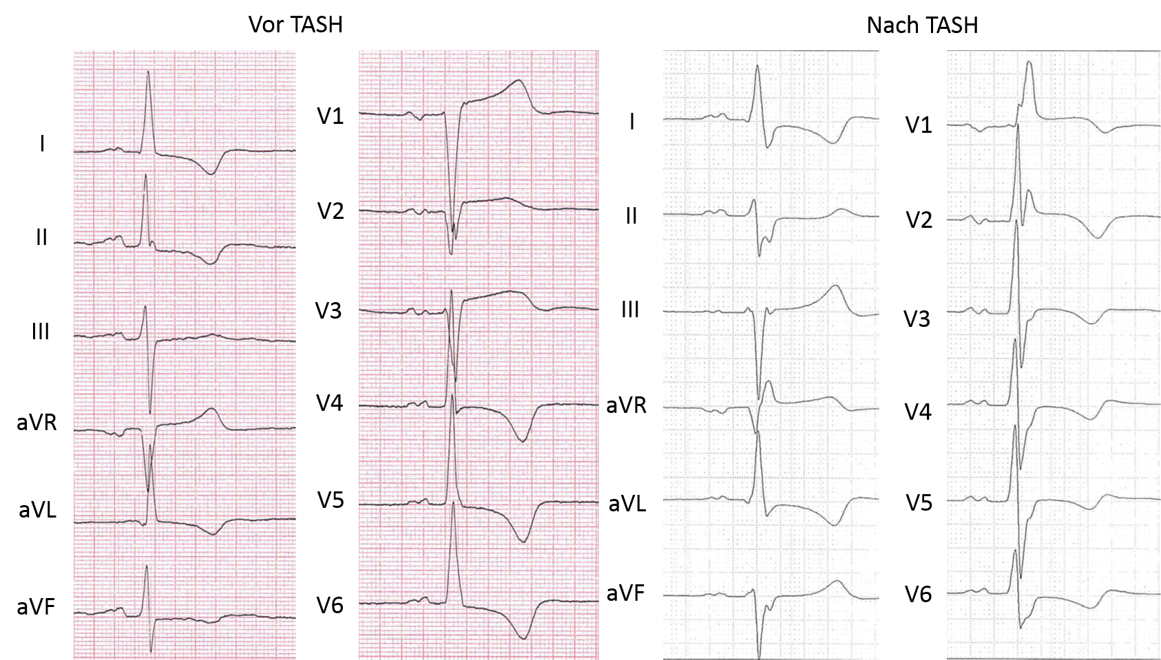 EKG bei hypertropher Kardiomyopathie - Fokus-EKG