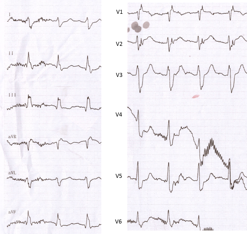 Lungenembolie S1Q3 _ Akute Lungenembolie – LDMH