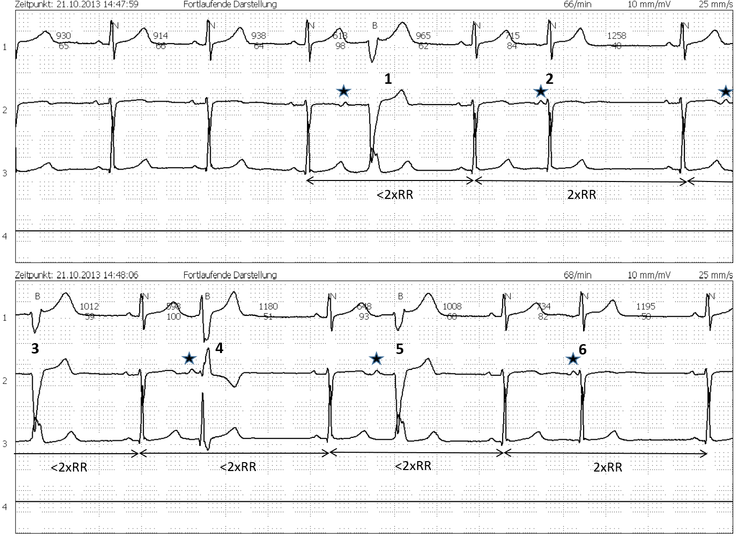 Supraventrikuläre Extrasystolen - Fokus-EKG