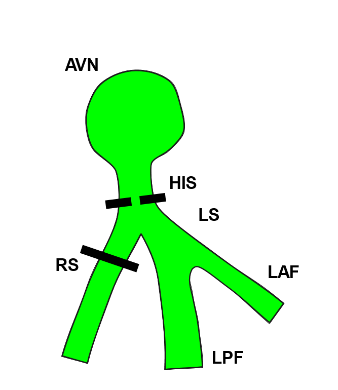 Faszikuläre Blockierungen (inkl. bi- und trifaszikulärer Block) - Fokus-EKG