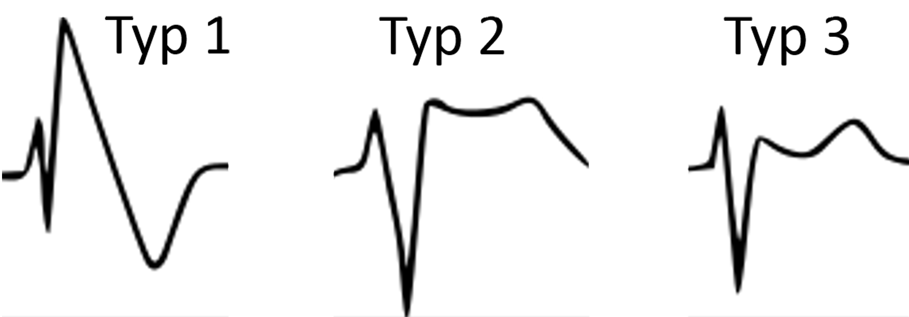 Brugada-Syndrom - Fokus-EKG