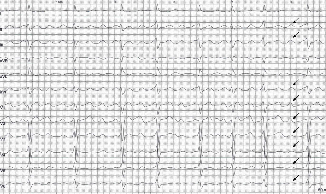 Vorhofflattern - Fokus-EKG