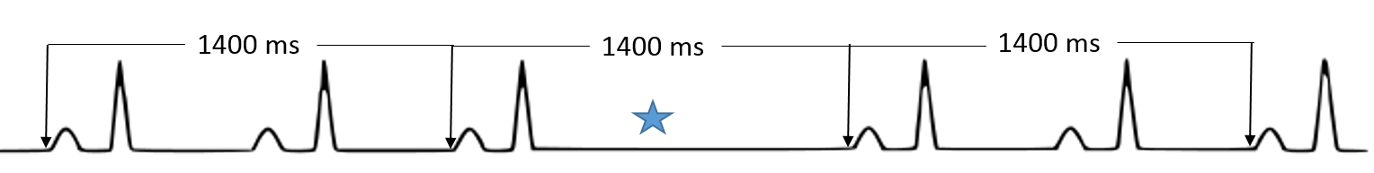 Sinuatriale Blockierungen - Fokus-EKG