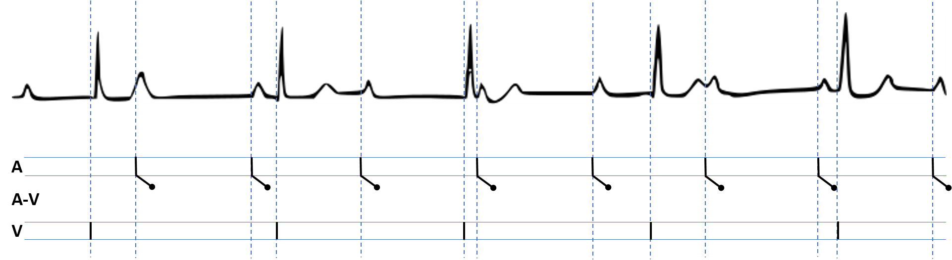Atrioventrikuläre Blockierungen - Fokus-EKG