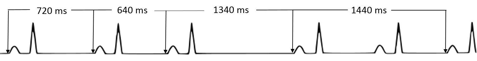 Sinuatriale Blockierungen - Fokus-EKG