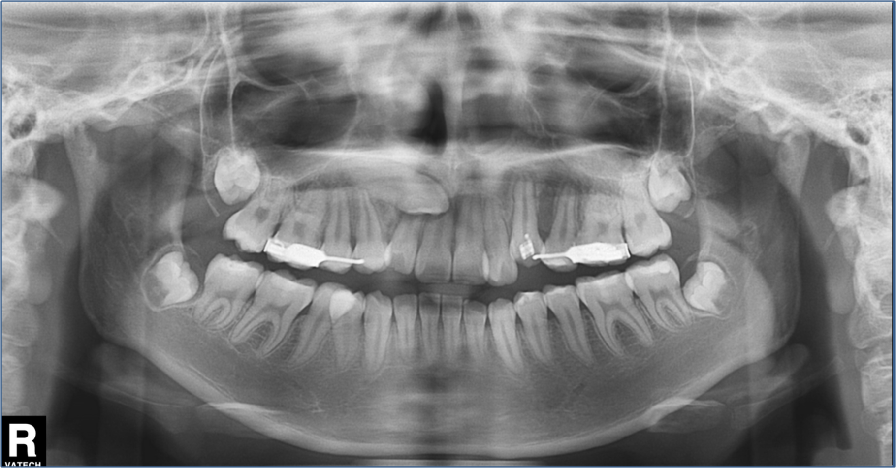 563: Reabsorción radicular externa - CDI