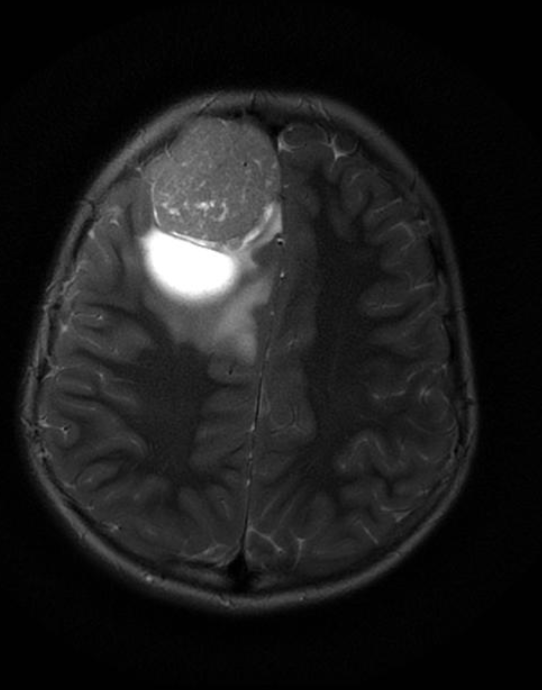 Ependymoma - NeurologyNeeds.com